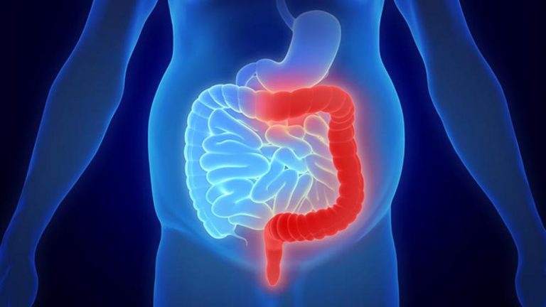¿Cómo se produce la colitis ulcerosa? - Ciudad 21 Turismo sostenible